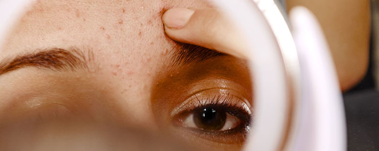 ACNE TREATMENTS - Dr Ayanda Motau